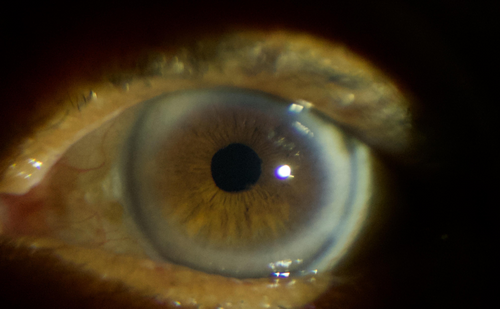 Remidio PSL D20 | Hand Held Portable Slit Lamp